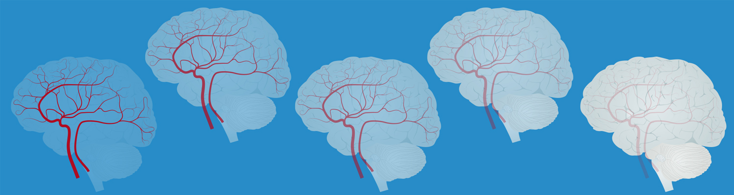 Stroke as a neurological disease
