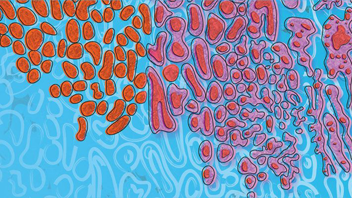 Photoselective Vaporization of the Prostate (PVP)